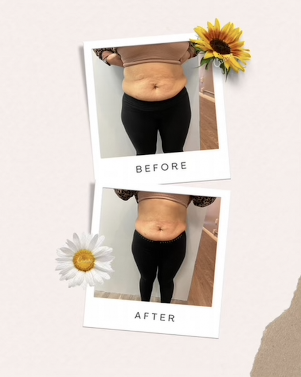 Body Contouring / Ultrasonic Cavitation Los Angeles | Electrolysis by ...